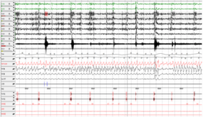 呼吸イベント終了時に生じるPLMはCPAP治療でどうなる？の続報｜ゆみのPSGケースカンファ｜活動報告｜医療法人社団ゆみの